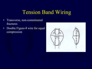 Patella fracture and extensor mechanism in injuries | PDF