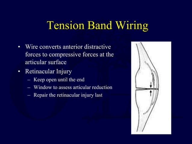 Patella fracture and extensor mechanism in injuries | PPT