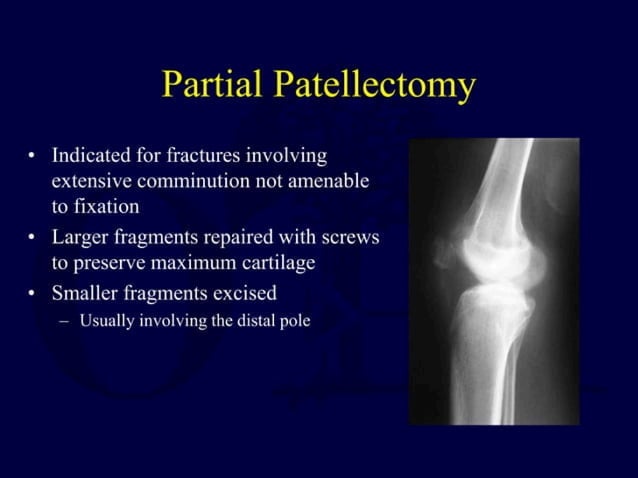 Patella fracture and extensor mechanism in injuries | PDF