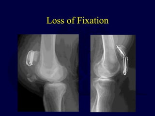 Patella fracture and extensor mechanism in injuries | PDF