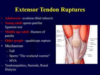 Patella fracture and extensor mechanism in injuries | PDF