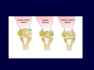 Patella fracture and extensor mechanism in injuries | PDF