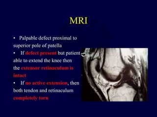 Patella fracture and extensor mechanism in injuries | PDF