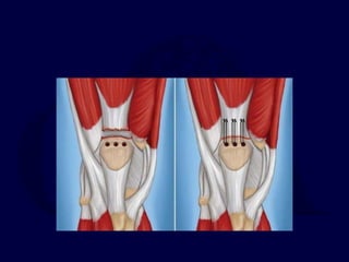 Patella fracture and extensor mechanism in injuries | PDF