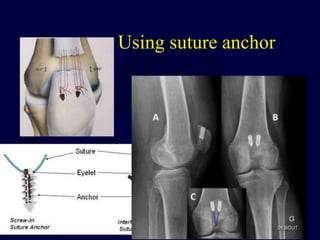 Patella fracture and extensor mechanism in injuries | PDF