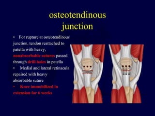 Patella fracture and extensor mechanism in injuries | PDF