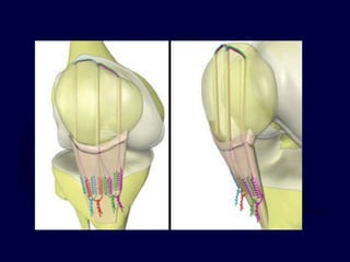 Patella fracture and extensor mechanism in injuries | PDF