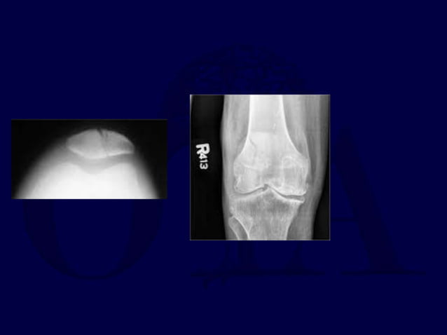 Patella fracture and extensor mechanism in injuries | PDF