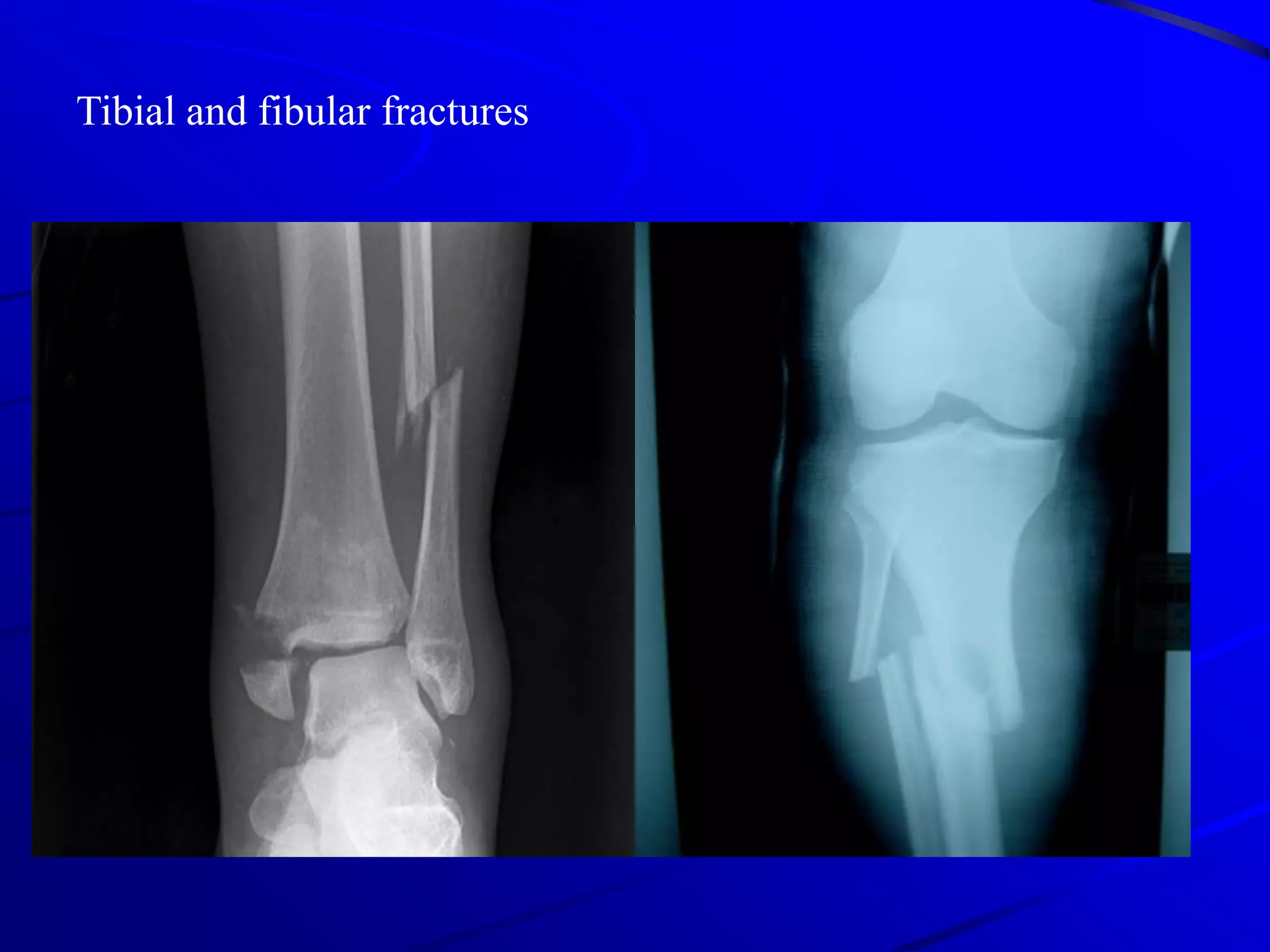 FRACTURES 0F LOWER LIMB | PPTX