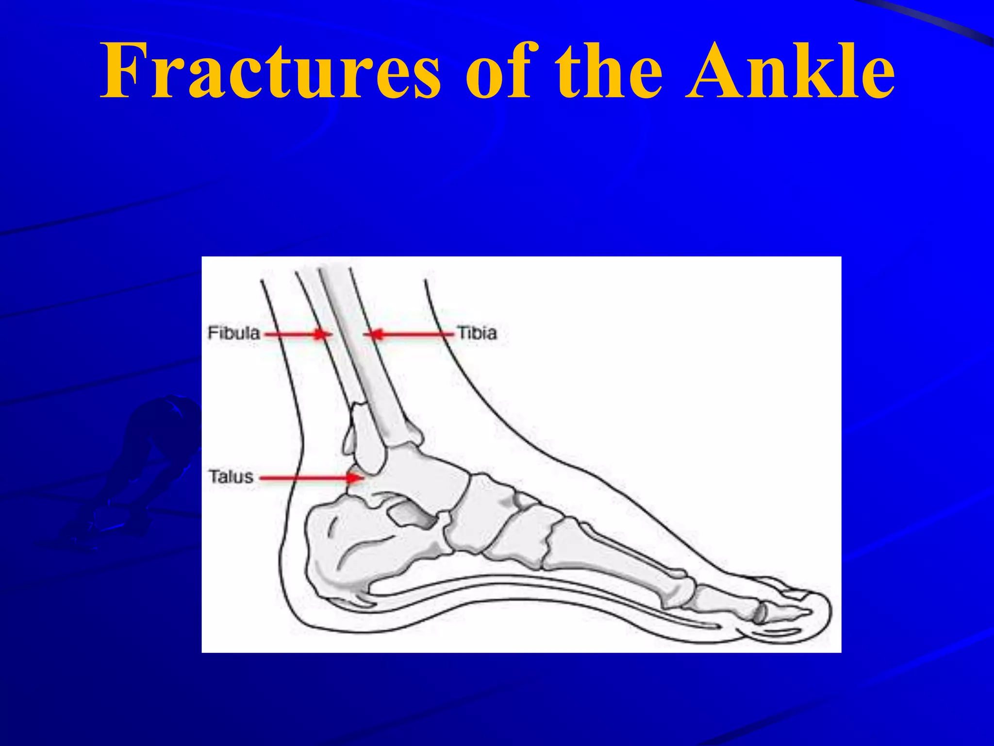 FRACTURES 0F LOWER LIMB | PPTX