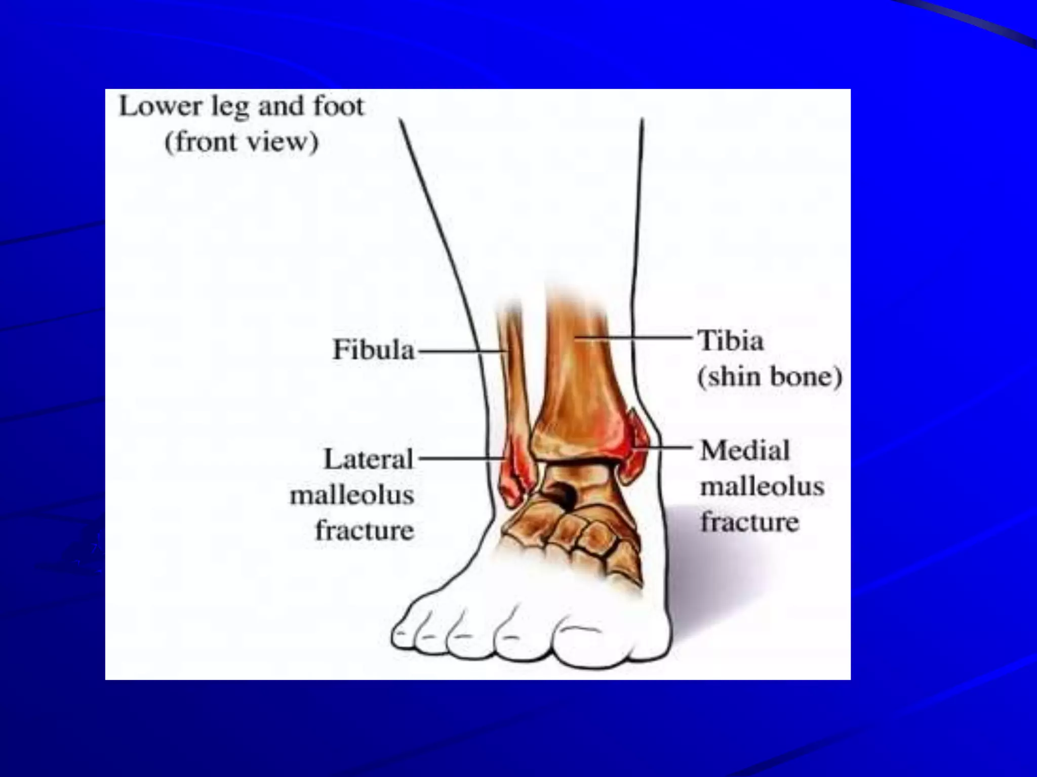 FRACTURES 0F LOWER LIMB | PPTX