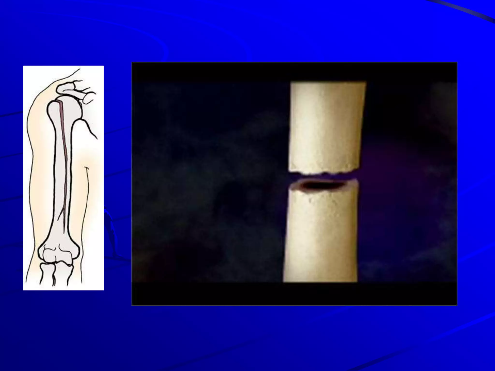 FRACTURES 0F LOWER LIMB | PPTX