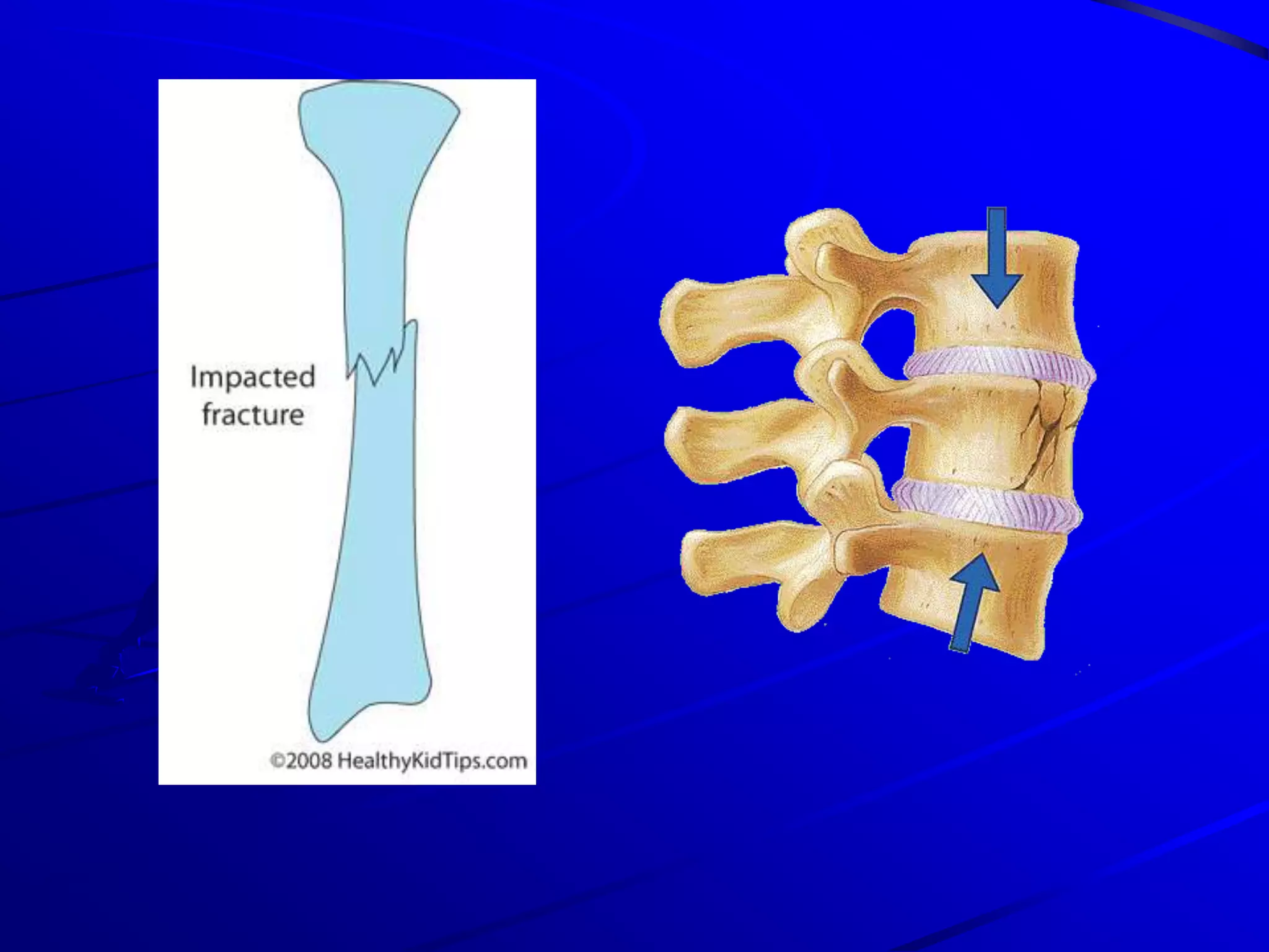 FRACTURES 0F LOWER LIMB | PPTX