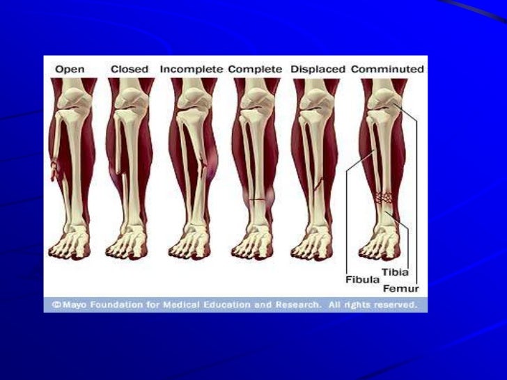 FRACTURES 0F LOWER LIMB