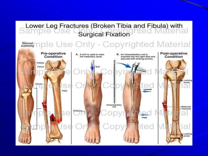 FRACTURES 0F LOWER LIMB