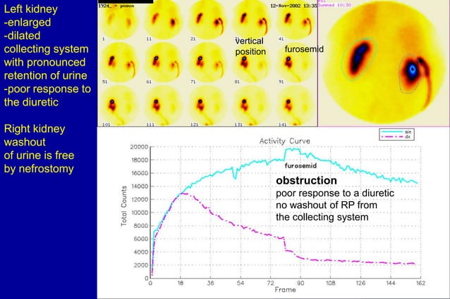 Renal Scan | PPT
