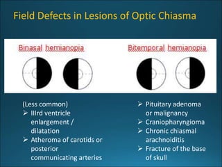 734_Visual_Pathway_lesions.pptx