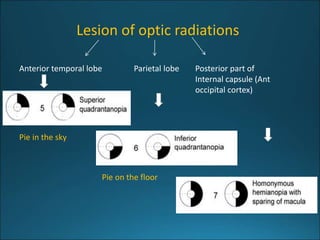 734_Visual_Pathway_lesions.pptx