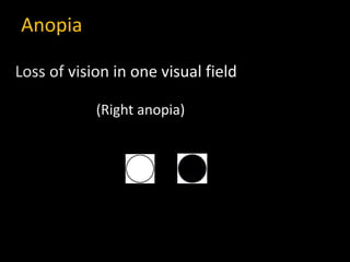 734_Visual_Pathway_lesions.pptx