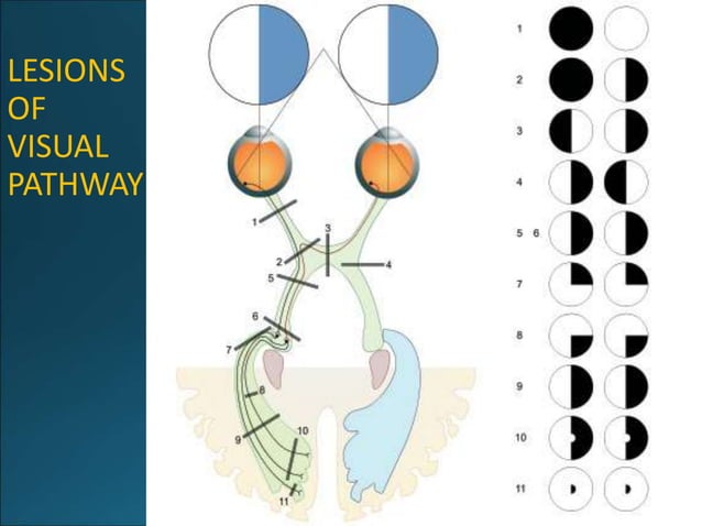 734_Visual_Pathway_lesions.pptx