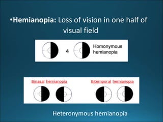 734_Visual_Pathway_lesions.pptx