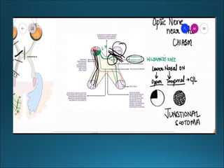 734_Visual_Pathway_lesions AND ANATOMY.ppt