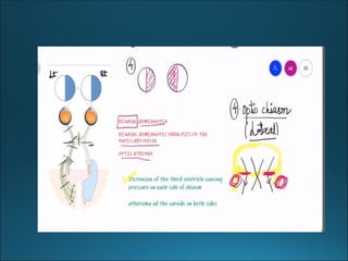 734_Visual_Pathway_lesions AND ANATOMY.ppt