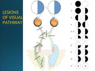 734_Visual_Pathway_lesions AND ANATOMY.ppt
