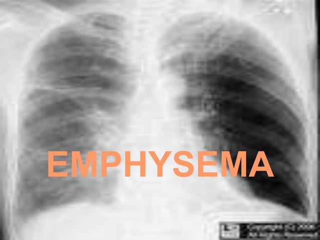 73721433-Emphysema.ppt