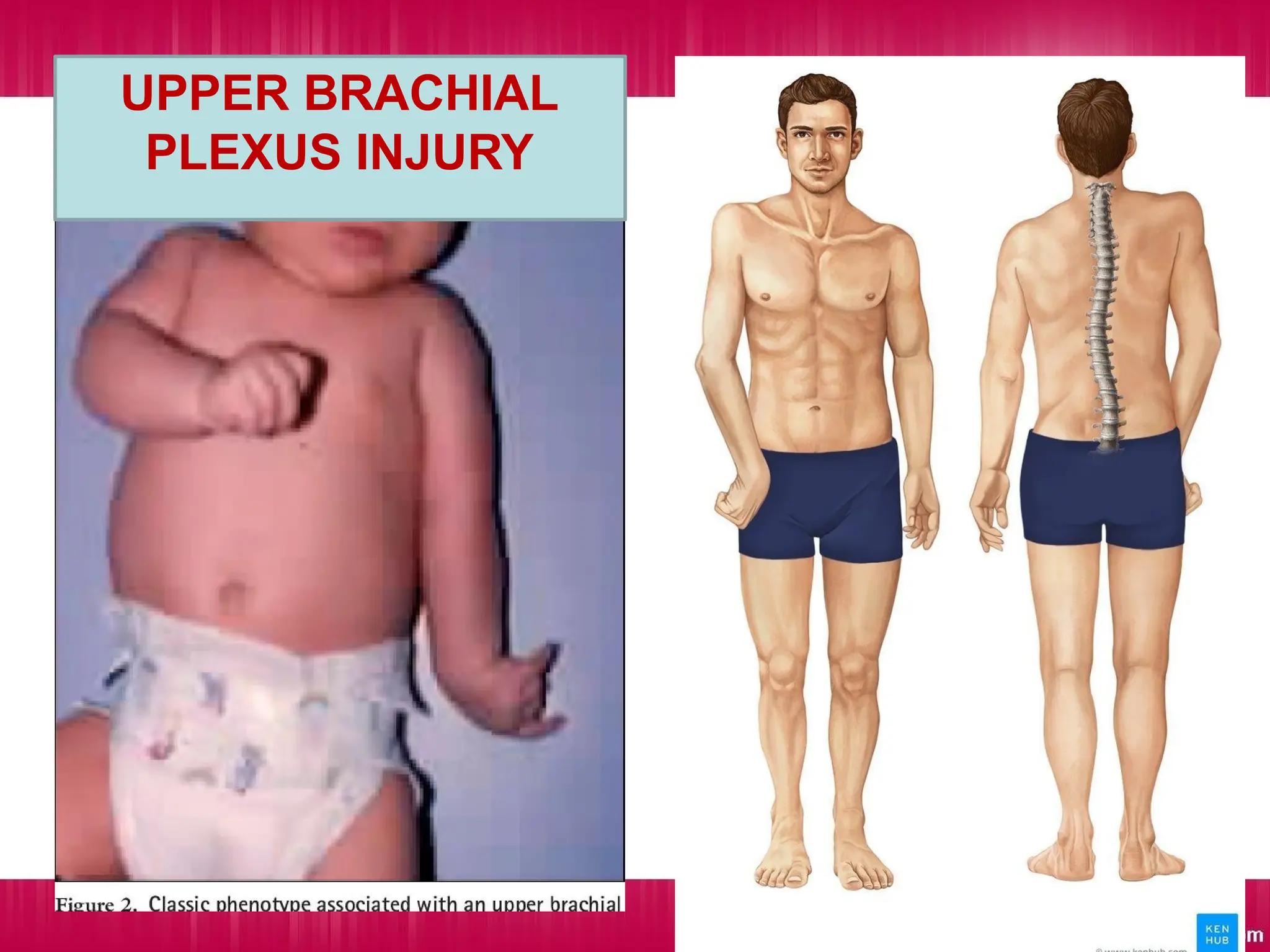 738150213-PPT-Plexopathy-DW0fadf822.pptx