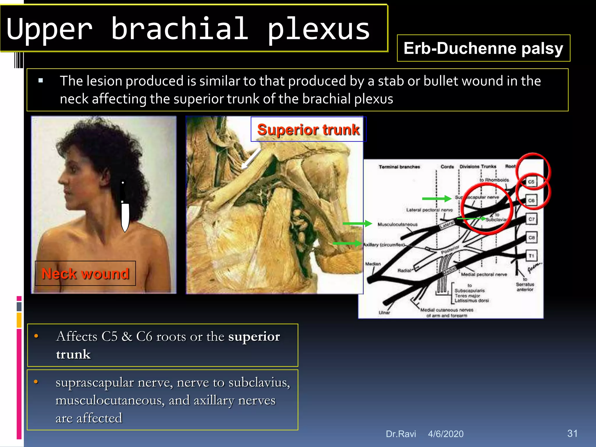 Brachial Plexus- Dr.K.S.Ravi