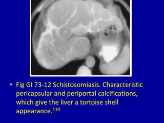 73 focal decreased attenuation masses in the liver | PPTX