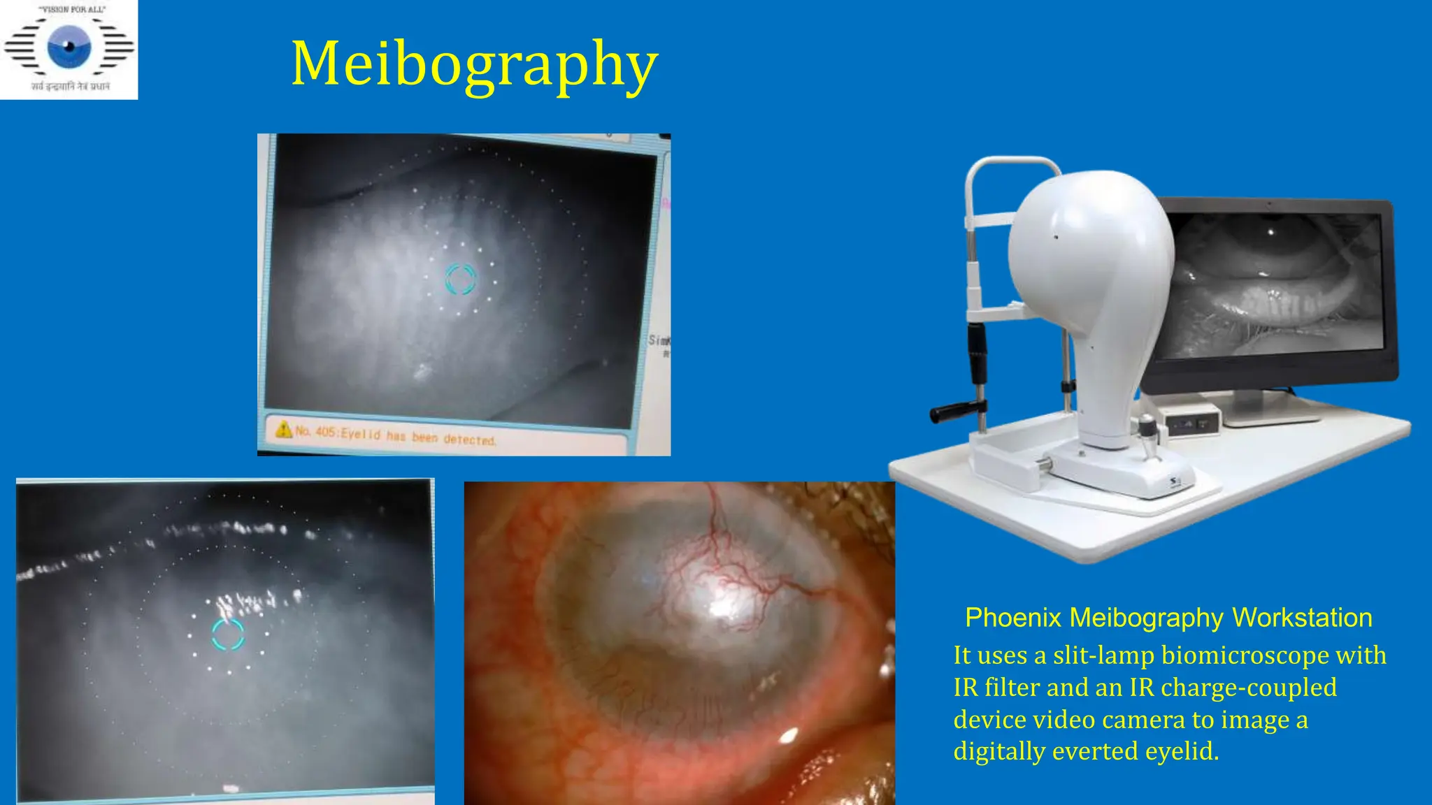 ARTIFICIAL_TEARS presentation dhir .pptx