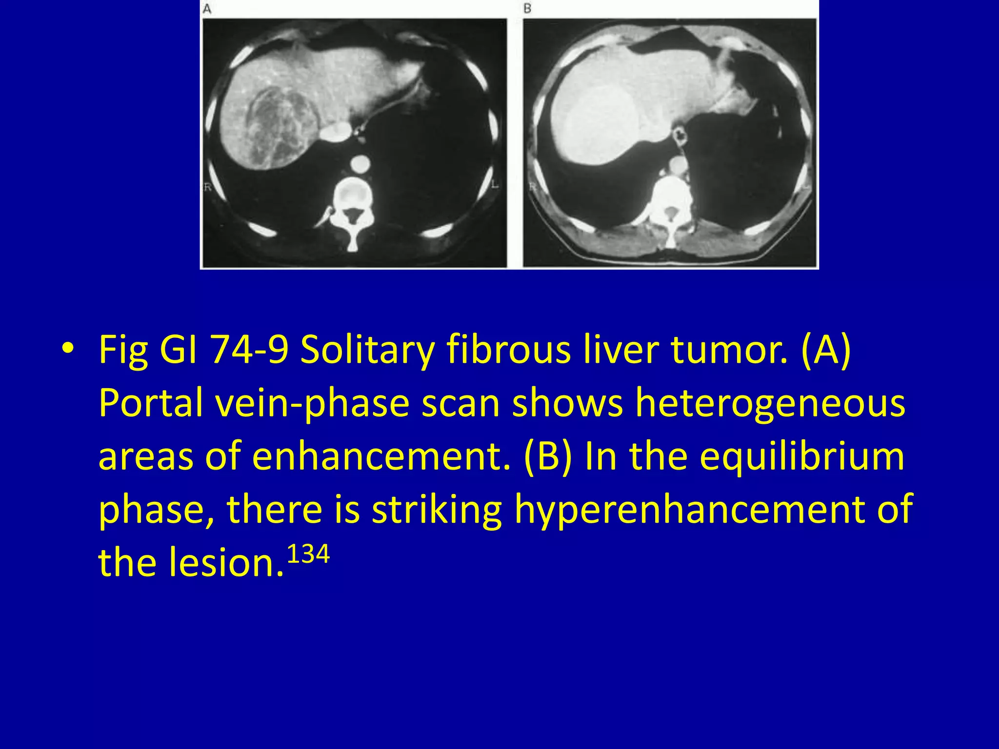 74 hyper enhancing focal liver lesions | PPTX
