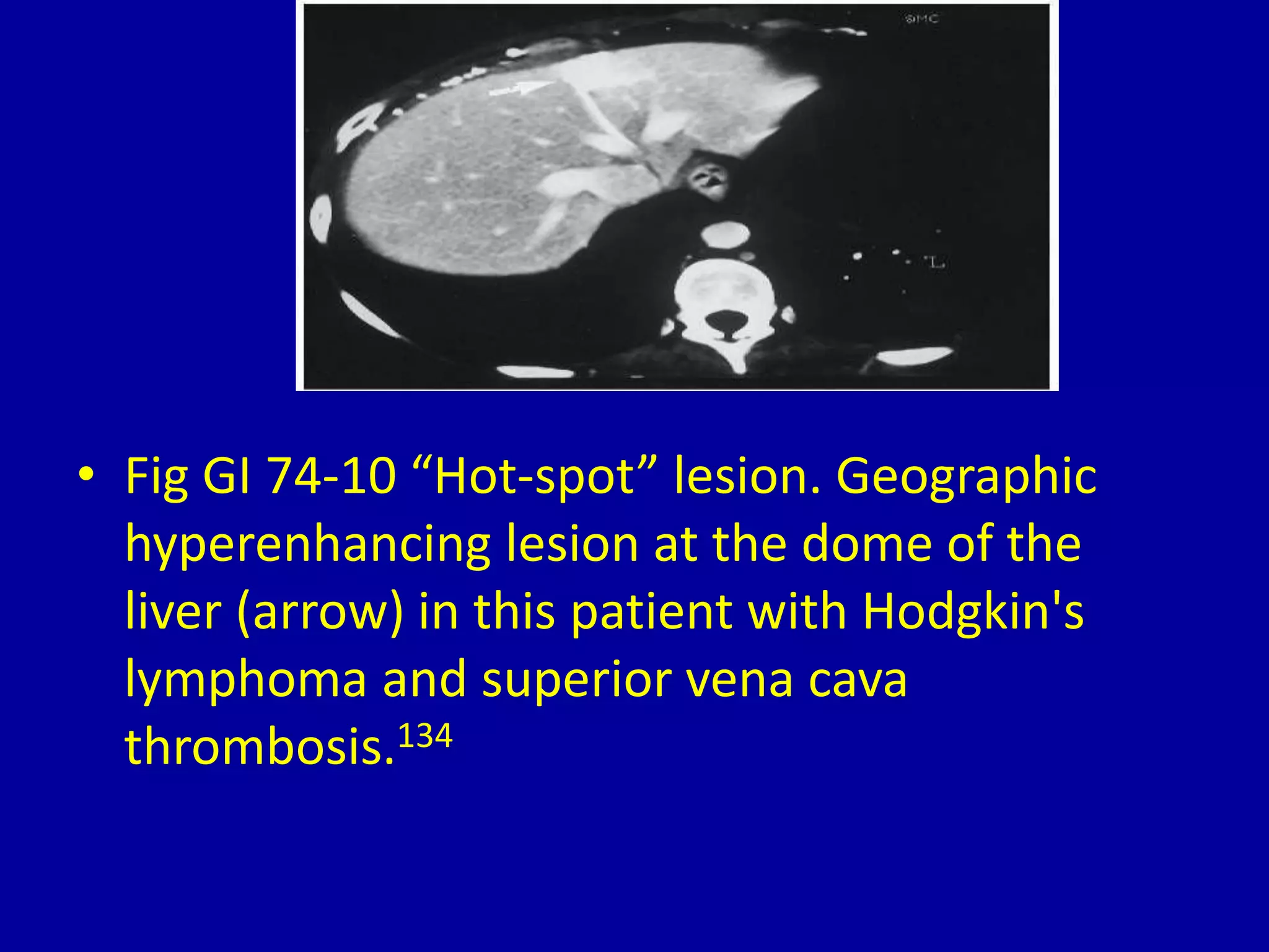 74 hyper enhancing focal liver lesions | PPTX