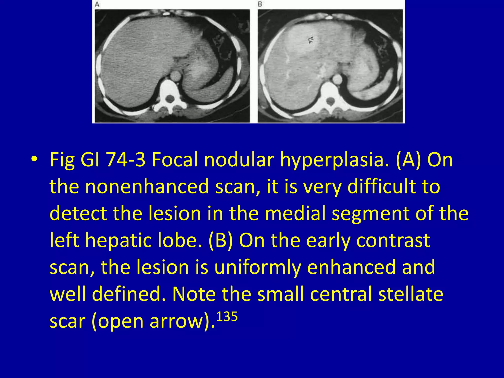 74 hyper enhancing focal liver lesions | PPTX