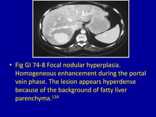 74 hyper enhancing focal liver lesions | PPTX