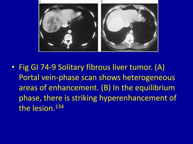 74 hyper enhancing focal liver lesions | PPT