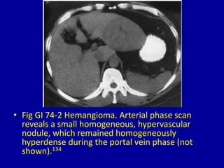 74 hyper enhancing focal liver lesions | PPT