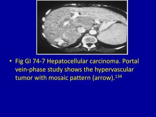 74 hyper enhancing focal liver lesions | PPT