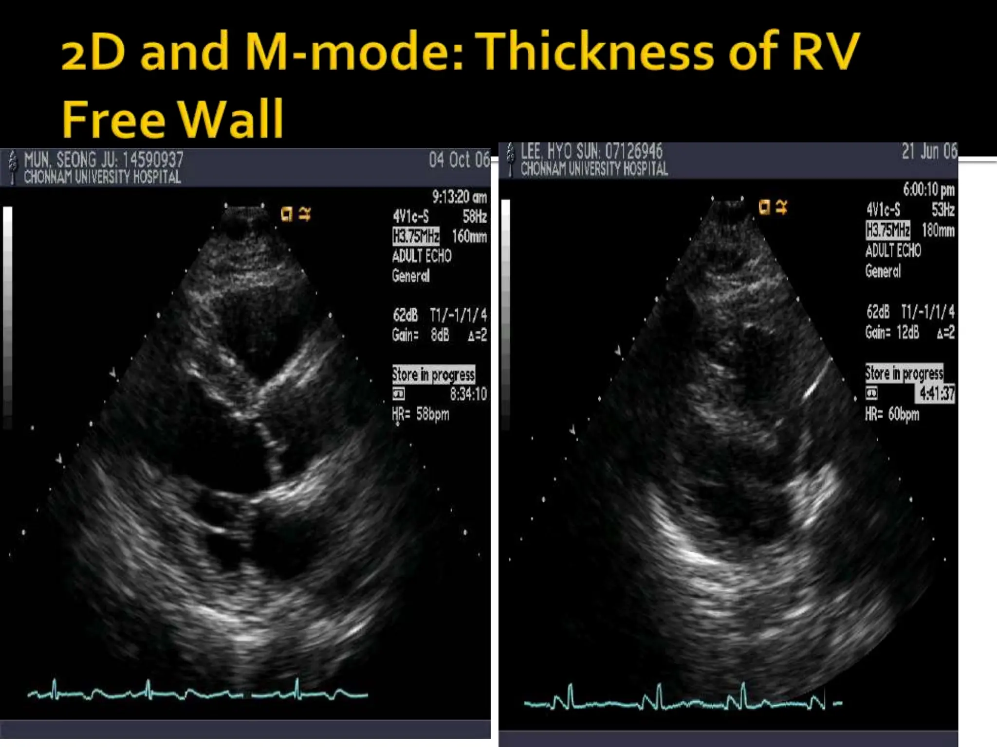 75574537-Assessment-of-Right-Ventricular-Function.ppt