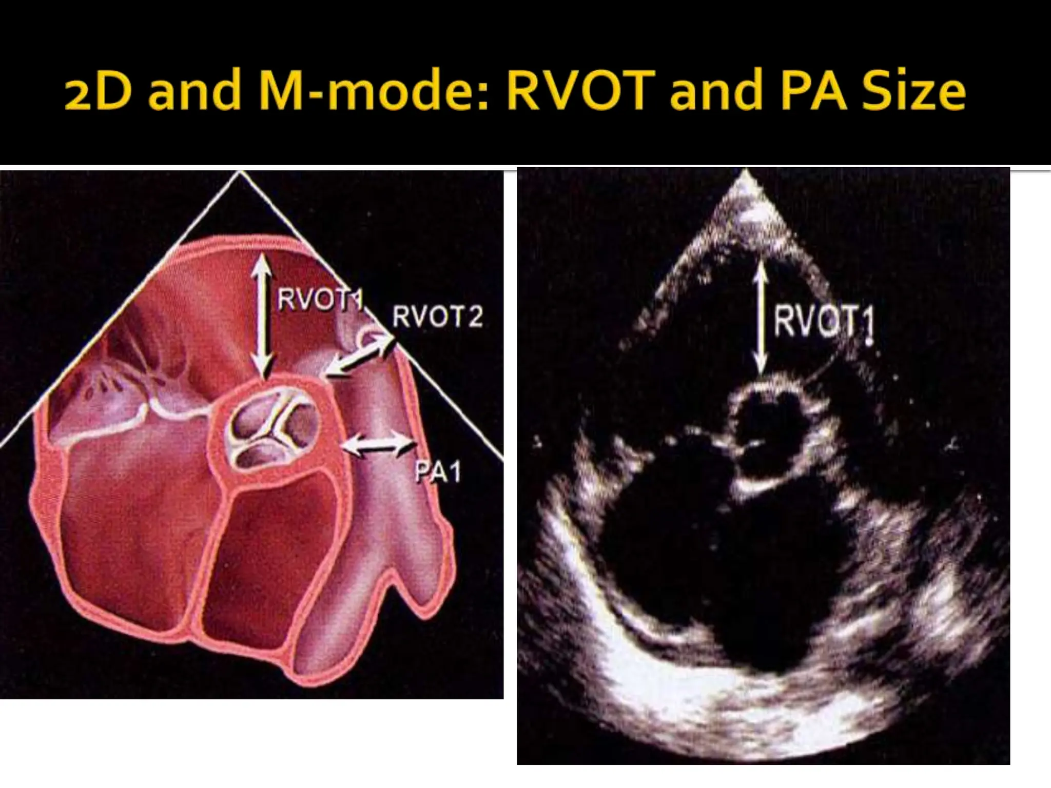 75574537-Assessment-of-Right-Ventricular-Function.ppt