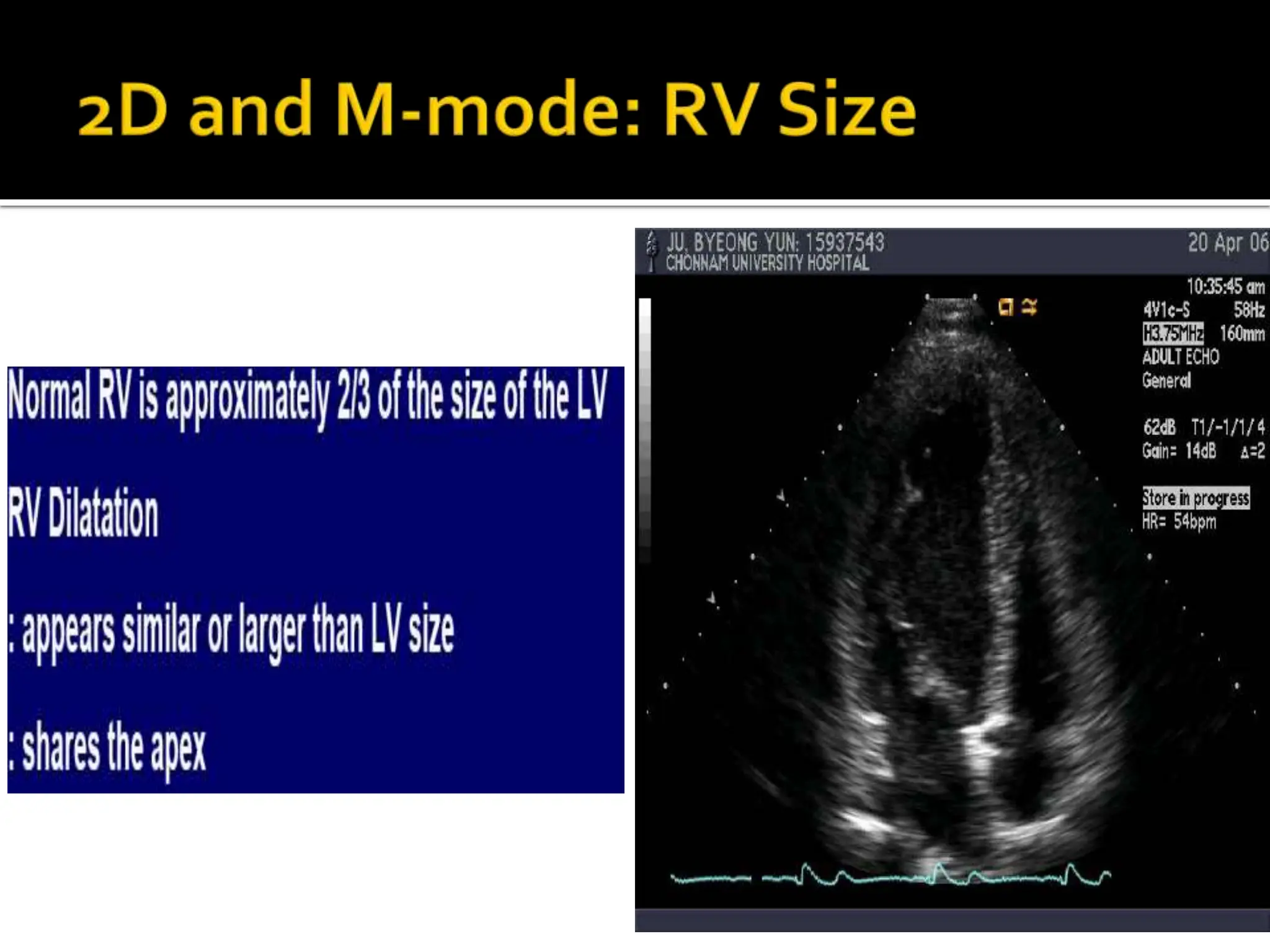75574537-Assessment-of-Right-Ventricular-Function.ppt