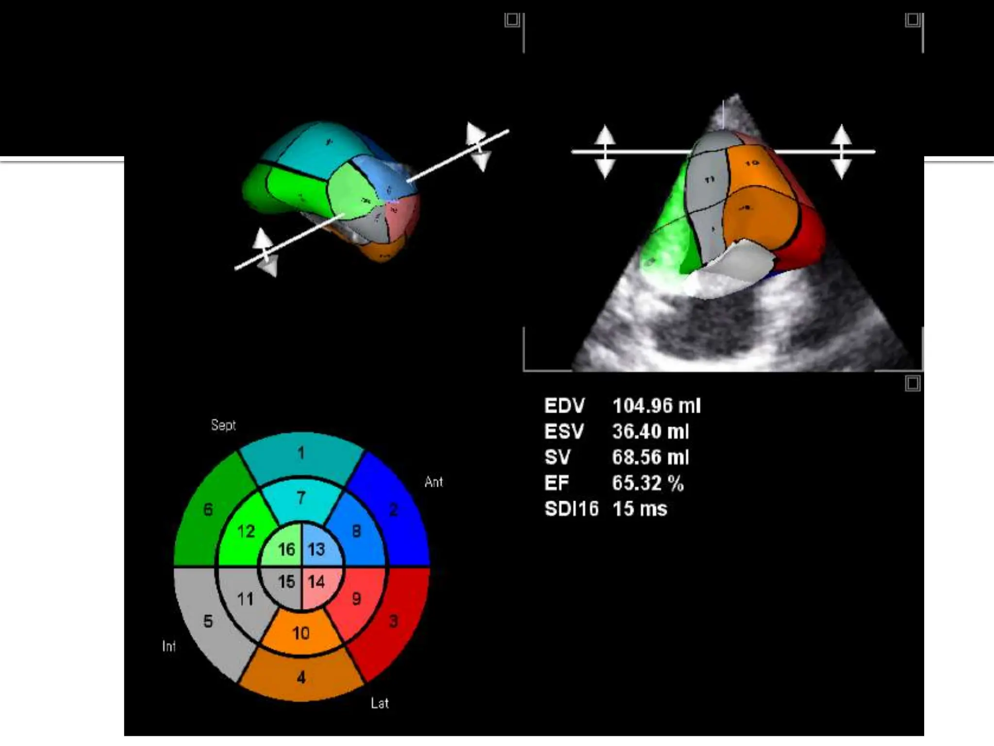 75574537-Assessment-of-Right-Ventricular-Function.ppt
