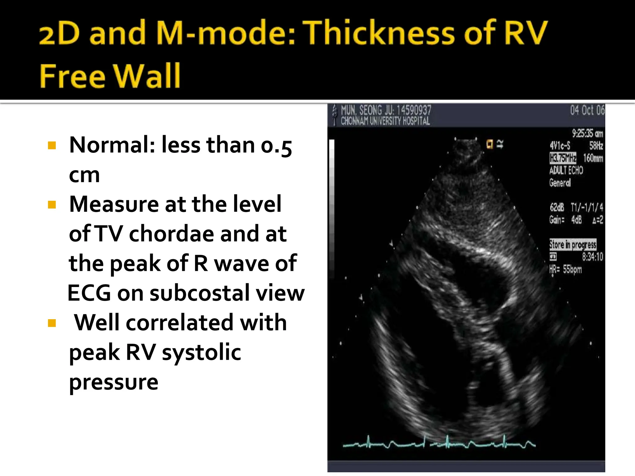 75574537-Assessment-of-Right-Ventricular-Function.ppt