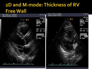 75574537-Assessment-of-Right-Ventricular-Function.ppt