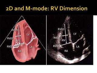 75574537-Assessment-of-Right-Ventricular-Function.ppt