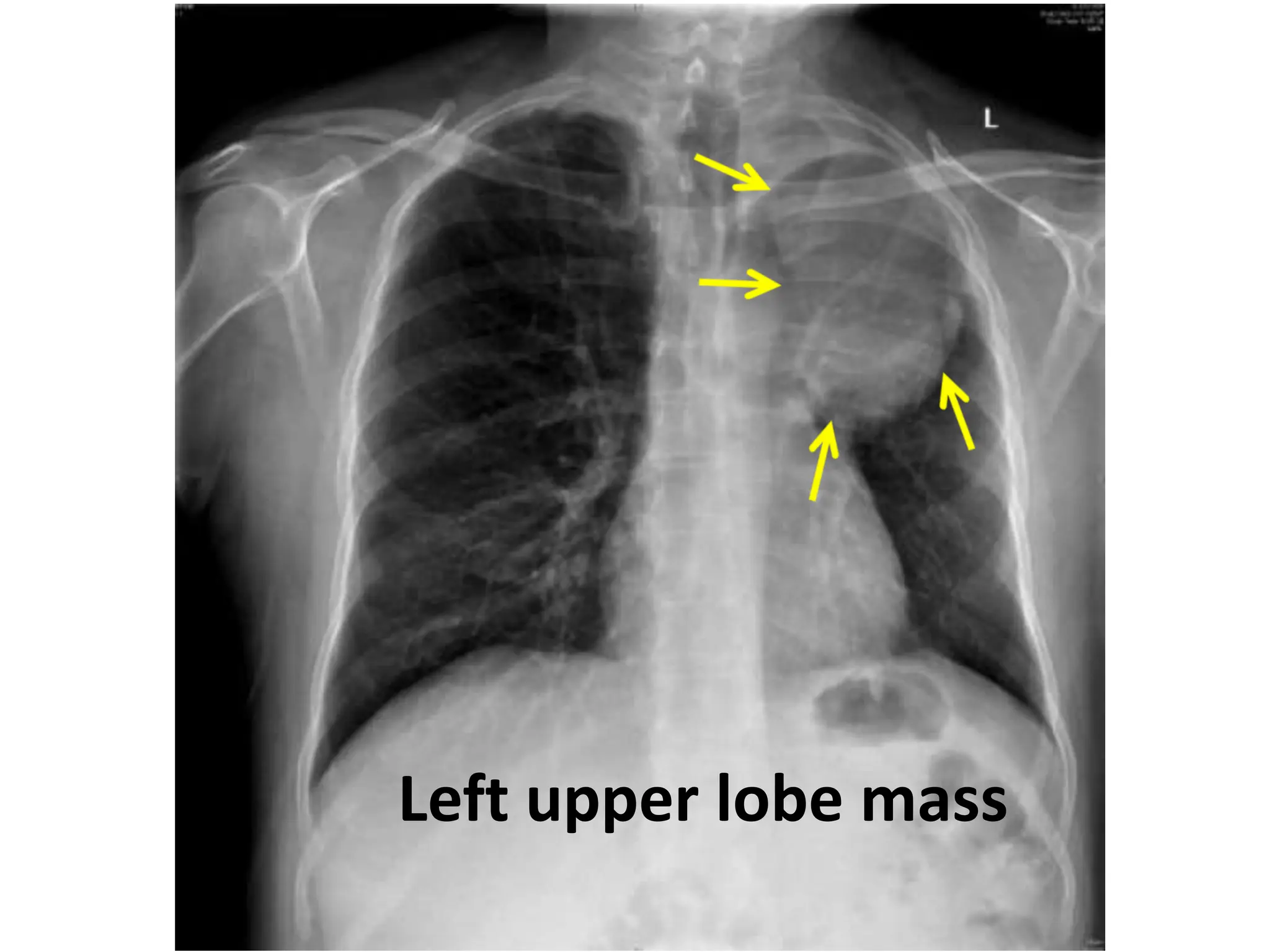Chest xray interpretation made easy basics | PPT