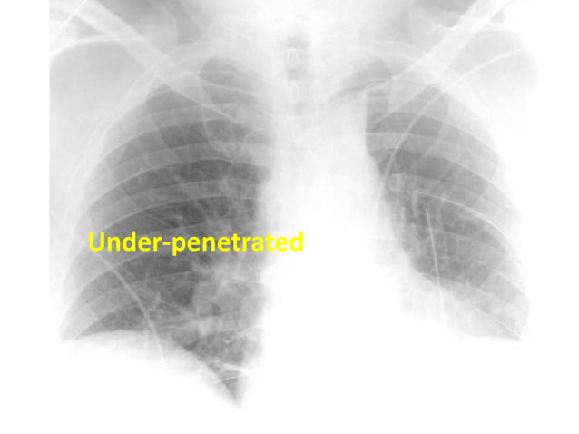 Chest xray interpretation made easy basics | PPT