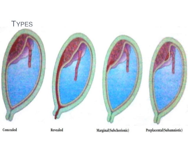 ABRUPTIO PLACENTAE (2) with animation